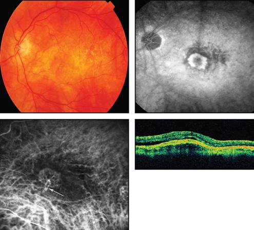 Retinal Physician | PentaVision