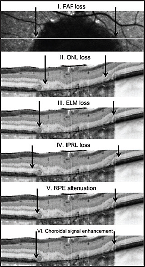 Retinal Physician | PentaVision
