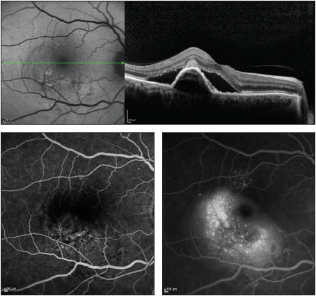Retinal Physician | PentaVision