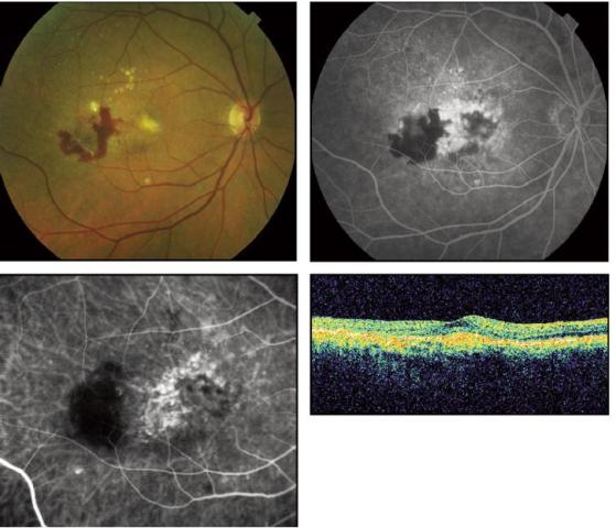 Retinal Physician | PentaVision