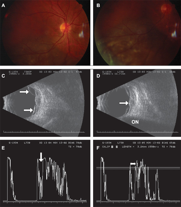 Retinal Physician | PentaVision