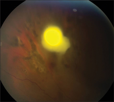 Retinal Physician | PentaVision