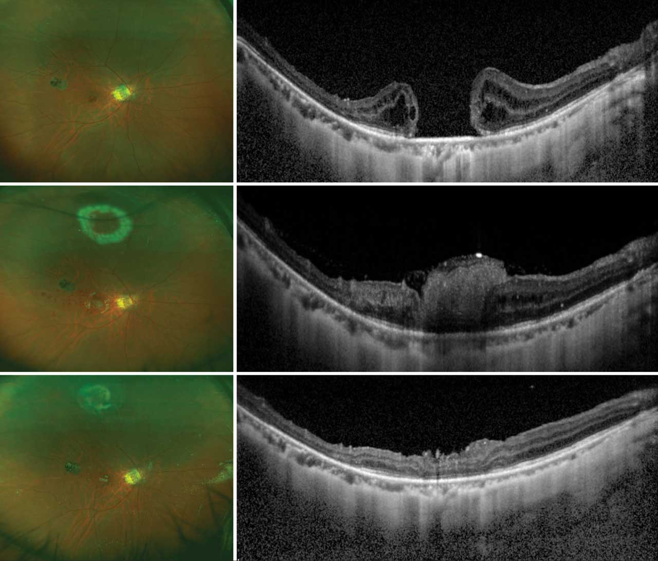 Tips for Managing Complicated Macular Holes | Retinal Physician