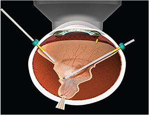 Retinal Physician | PentaVision