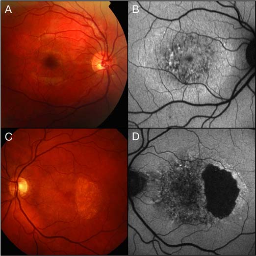 Retinal Physician | PentaVision