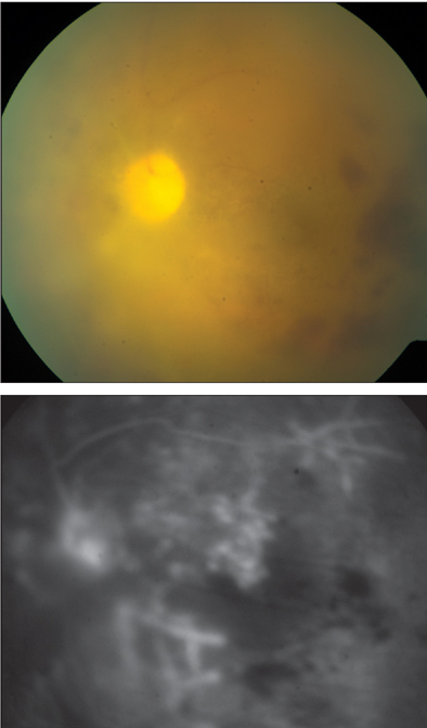 Retinal Physician | PentaVision