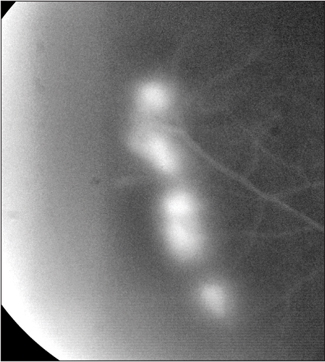 Retinal Physician | PentaVision