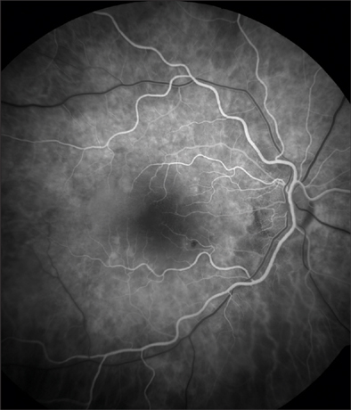 Retinal Physician | PentaVision