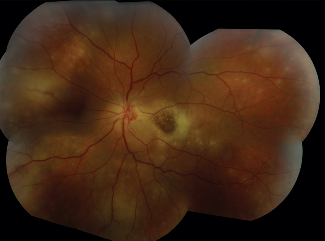 Retinal Physician | PentaVision