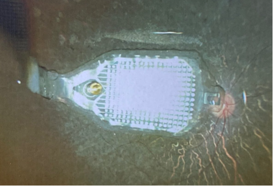 Overview of Retinal Prosthesis and Future Directions | Retinal Physician