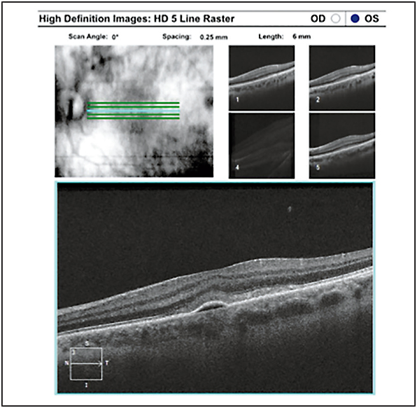 Retinal Physician | PentaVision