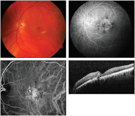 Retinal Physician | PentaVision