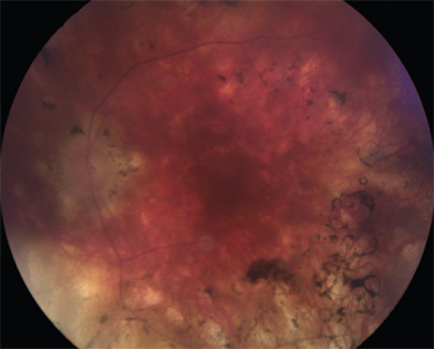 Retinal Physician | PentaVision