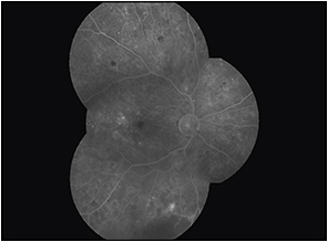 Retinal Physician | PentaVision