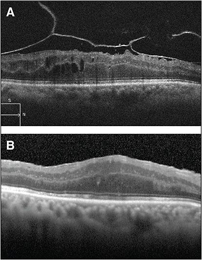 Retinal Physician | PentaVision