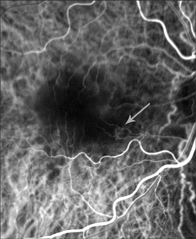 Retinal Physician | PentaVision