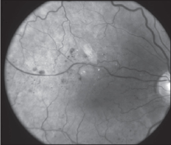Retinal Physician | PentaVision