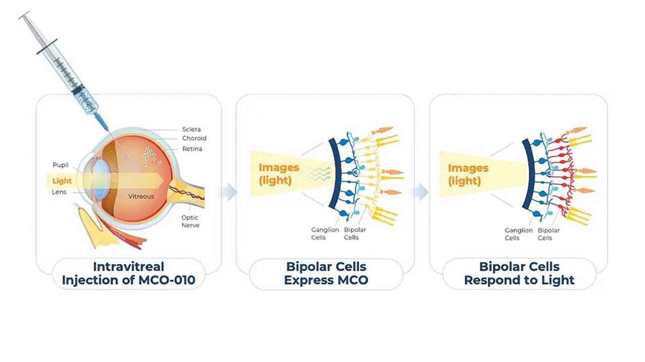 Clinical Trial Download: The Potential of Optogenetic Therapy | Retinal ...