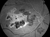 Retinal Physician | PentaVision