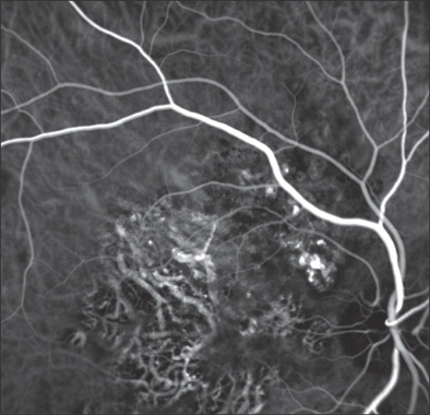 Retinal Physician | PentaVision