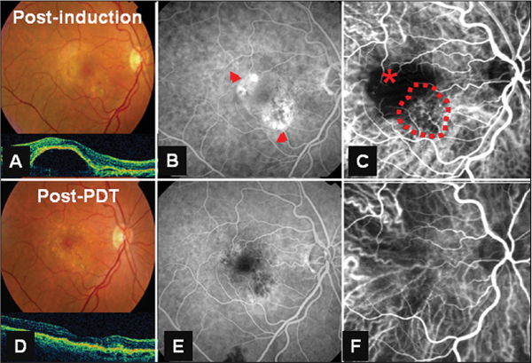 Retinal Physician | PentaVision