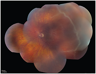 Retinal Physician | PentaVision