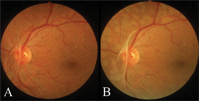 Retinal Physician | PentaVision