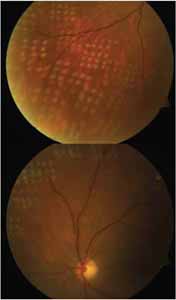 Retinal Physician | PentaVision