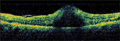 Retinal Physician | PentaVision