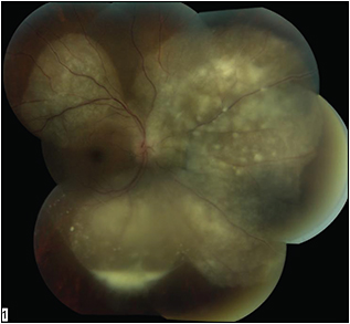 Retinal Physician | PentaVision