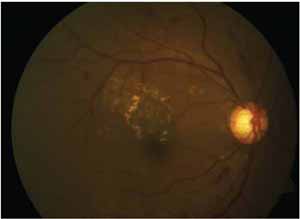 Retinal Physician | PentaVision