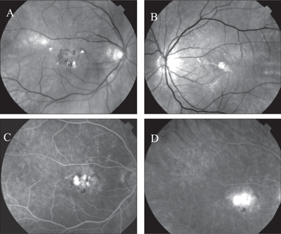 Retinal Physician | PentaVision