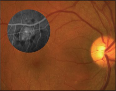 Retinal Physician | PentaVision