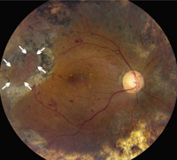 Retinal Physician | PentaVision