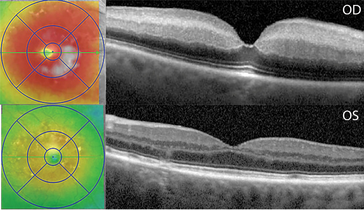 Remote OCT Protocol to Speed Diagnosis and Treatment of CRAO | Retinal ...