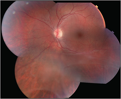 Retinal Physician | PentaVision