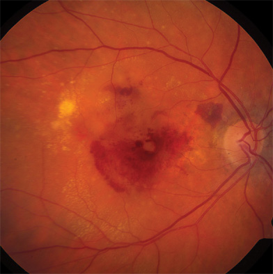 Retinal Physician | PentaVision