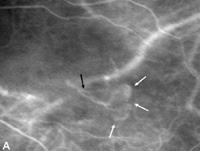 Retinal Physician | PentaVision