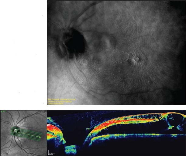 Retinal Physician | PentaVision