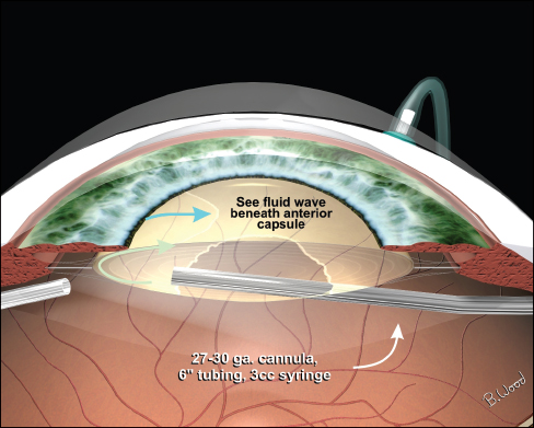 Retinal Physician | PentaVision