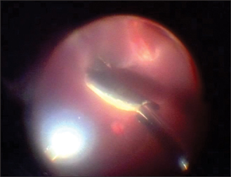 Retinal Physician | PentaVision