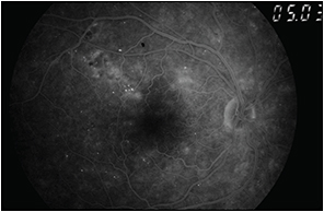 Retinal Physician | PentaVision