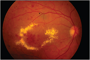 Retinal Physician | PentaVision