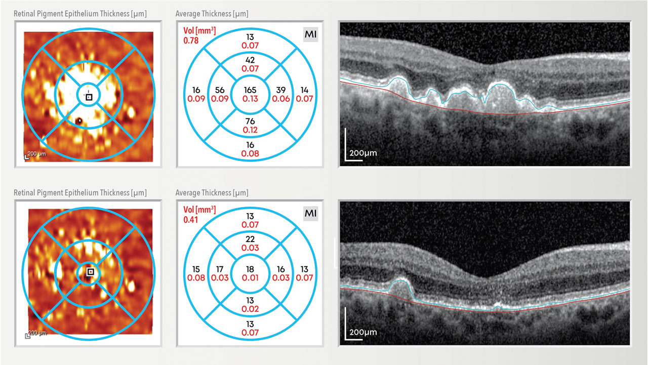 Photobiomodulation Therapy Delays Dry AMD Progression | Retinal Physician