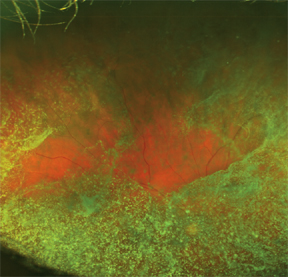 Retinal Physician | PentaVision