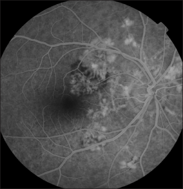 Retinal Physician | PentaVision