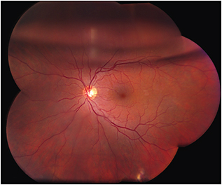 Retinal Physician | PentaVision