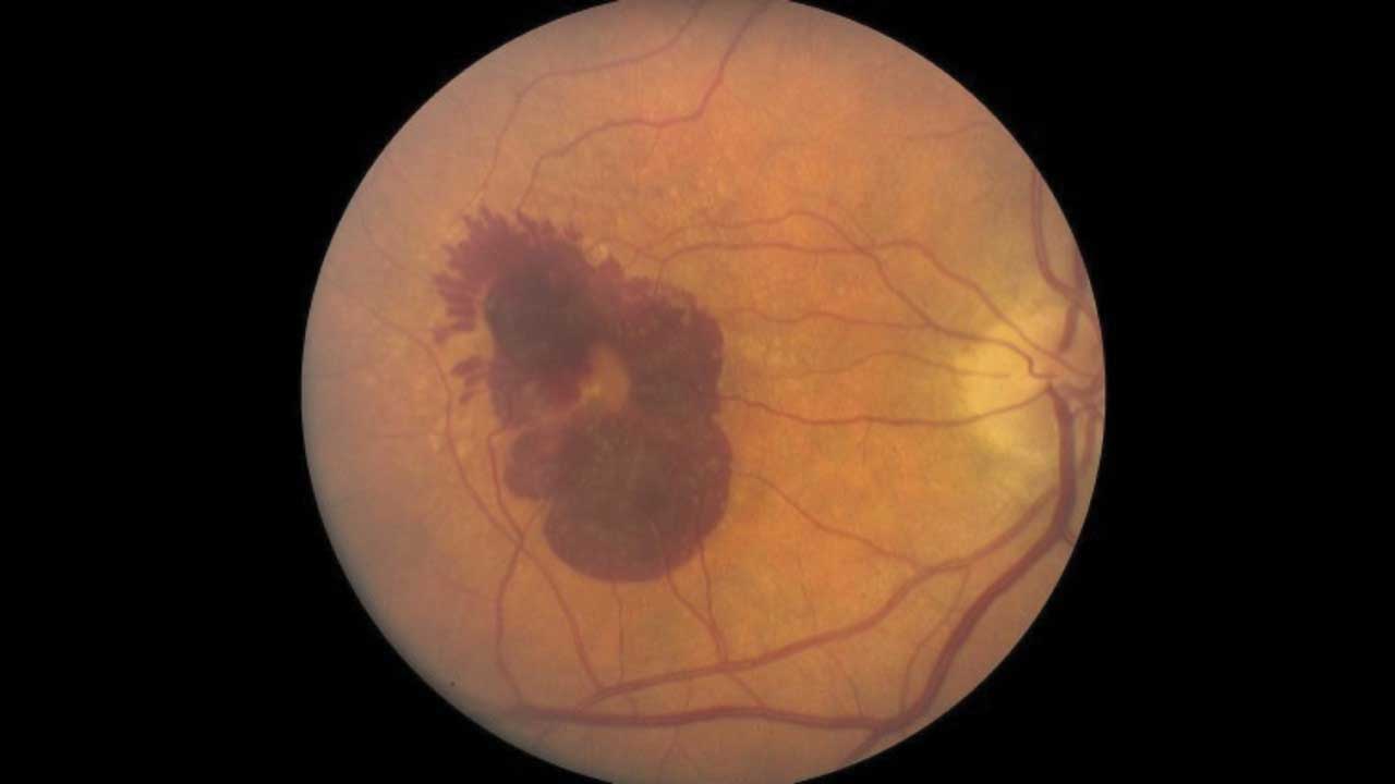 Wet Amd Ophthalmology