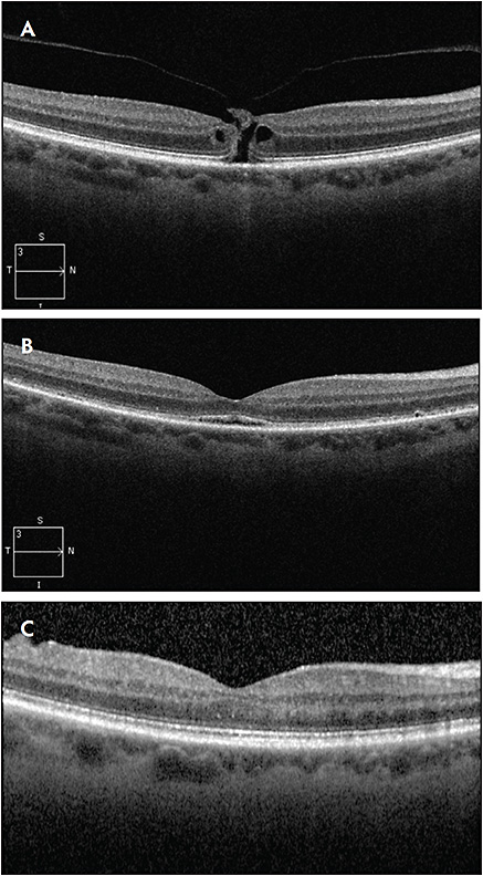 Retinal Physician | PentaVision