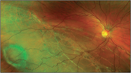 Retinal Physician | PentaVision